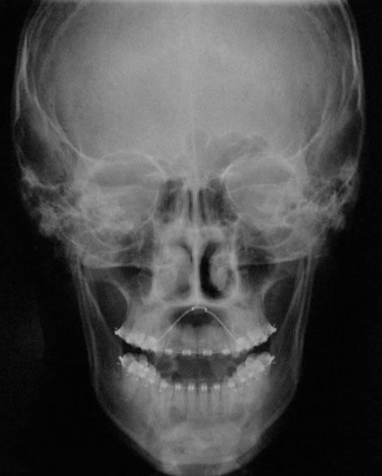 Radiografía Postero Anterior Cadwell