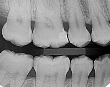Radiografía Bitewing
